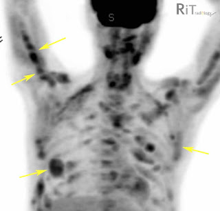 RiT radiology: FDG-PET and Multiple Myeloma