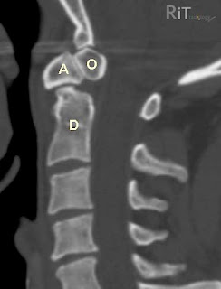 RiT radiology: Os Terminale - Os Odontoideum Complex (3)