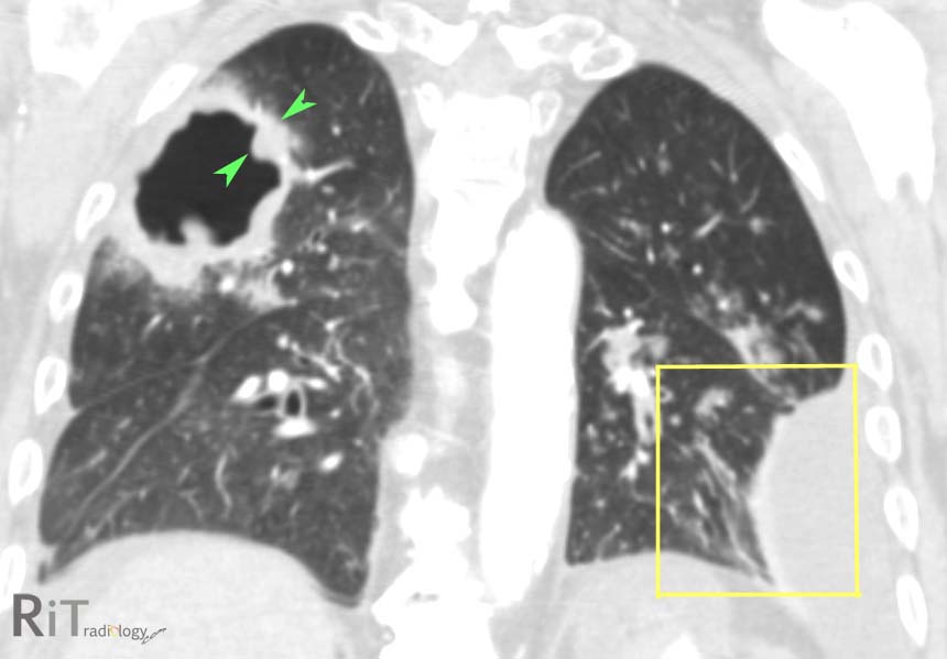 RiT radiology: Lung Abscess versus Empyema