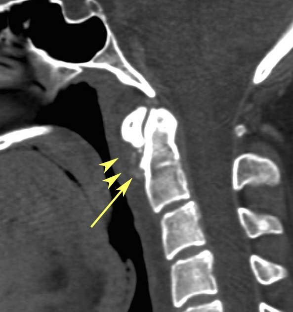 RiT radiology: Calcific Tendinitis of the Longus Colli