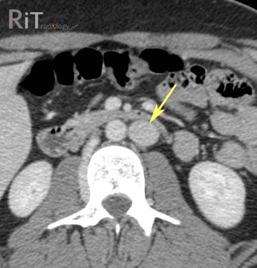 RiT radiology: Left Inferior Vena Cava (IVC)