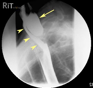 RiT radiology: Zenker's Diverticulum