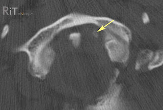 RiT radiology: Occipital Condylar Fracture