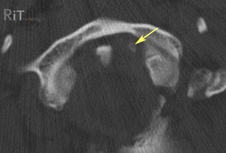 RiT radiology: Occipital Condylar Fracture
