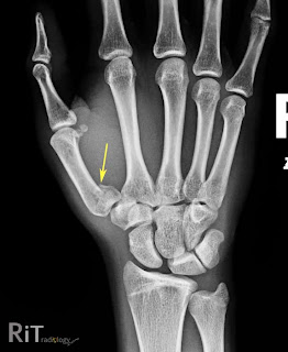 RiT radiology: Bennett's Fracture Dislocation