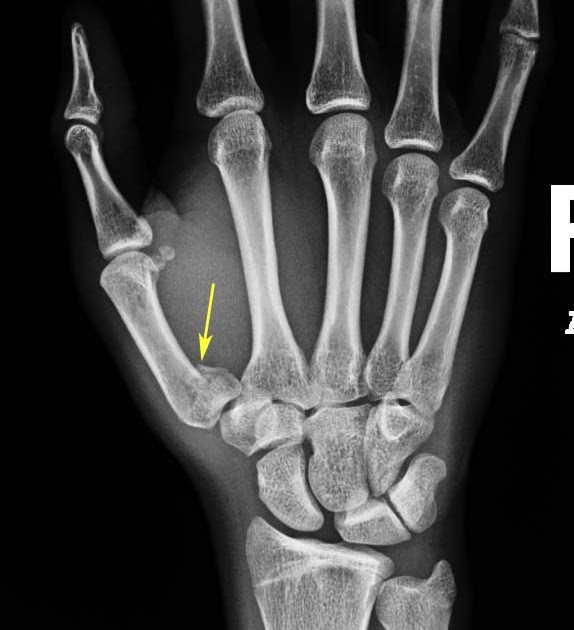 RiT radiology: Bennett's Fracture Dislocation