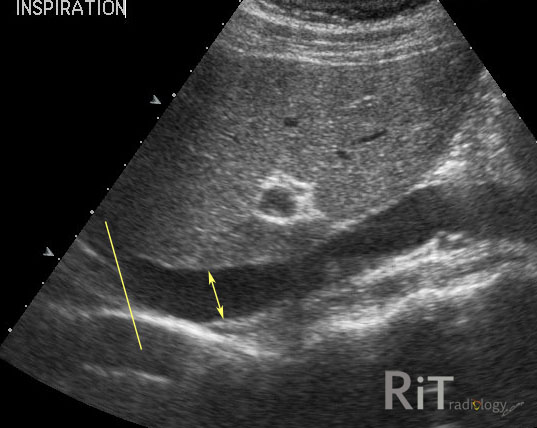 RiT radiology: Caval Index