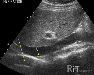RiT radiology: Caval Index