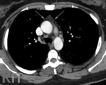 RiT radiology: Thymic Involution