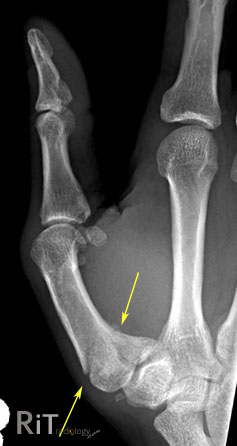 RiT radiology: Rolando Fracture