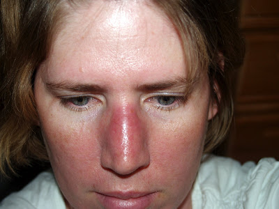 Facial cellulitis