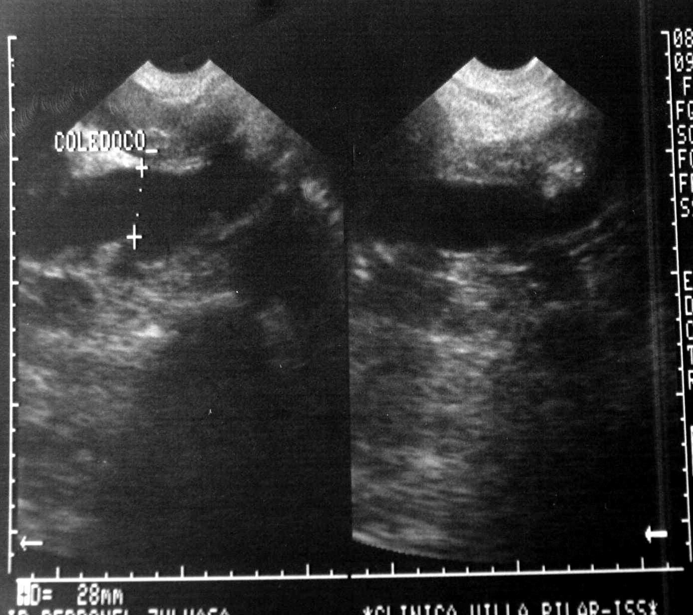 Endoscopia y Cirugía Digestiva: COLEDOCOLITIASIS