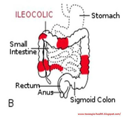 TooSogiE Medical Images: IMAGES OF CROHN'S DISEASE