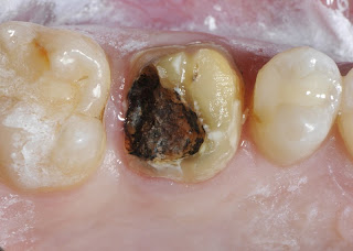 James Mahooti DDS: Tooth decay under crowns. What is leakage? How ...