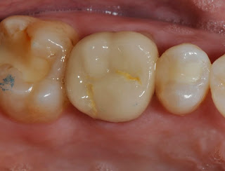 James Mahooti DDS: Tooth decay under crowns. What is leakage? How ...