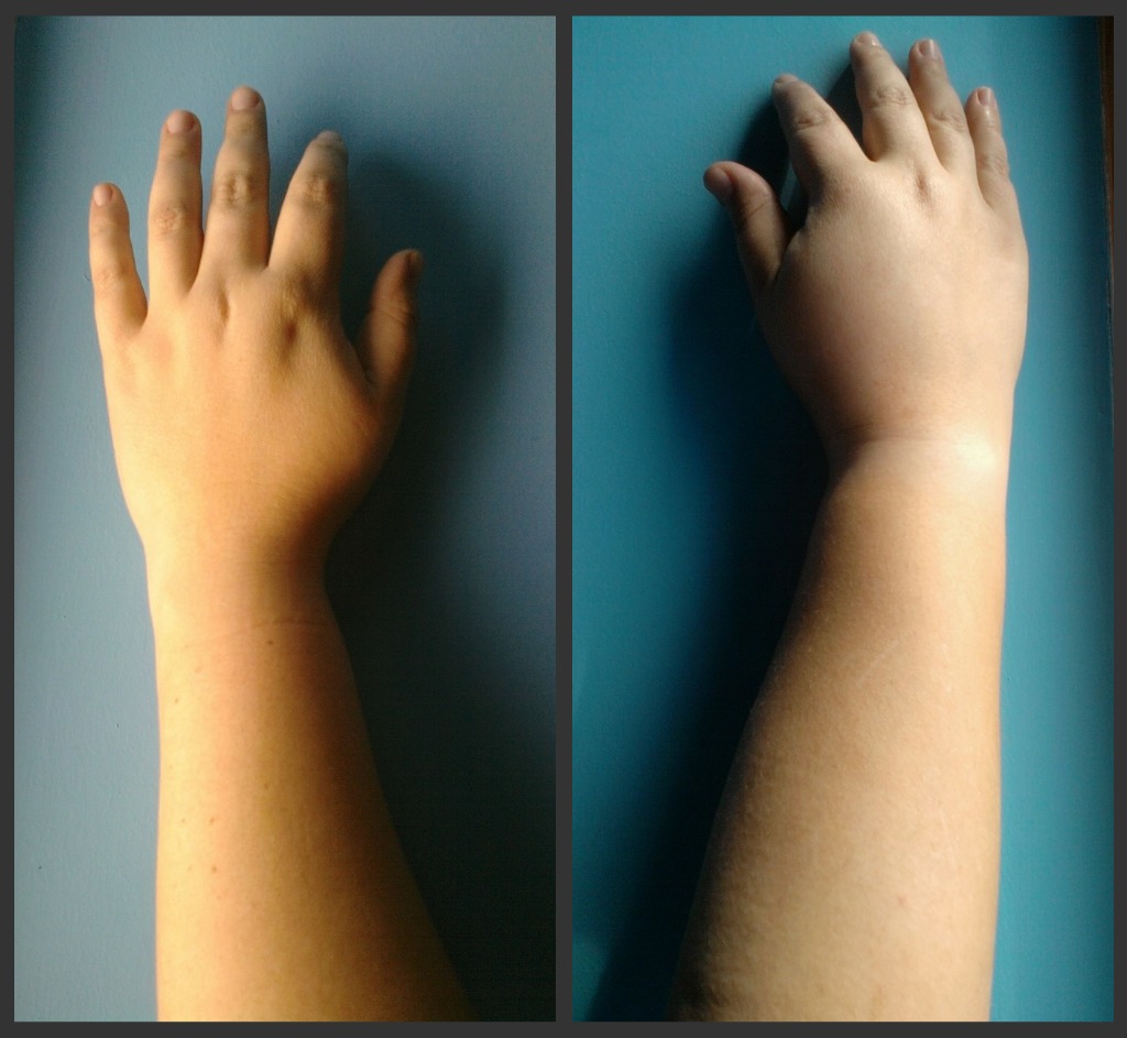 My normal life (antes Carrapuchiña): asi estoy yo... con el brazo infectado