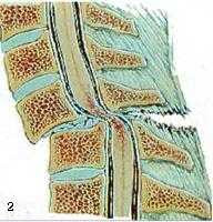 Fisioterapia - Arte em Reabilitar: Lesão Medular