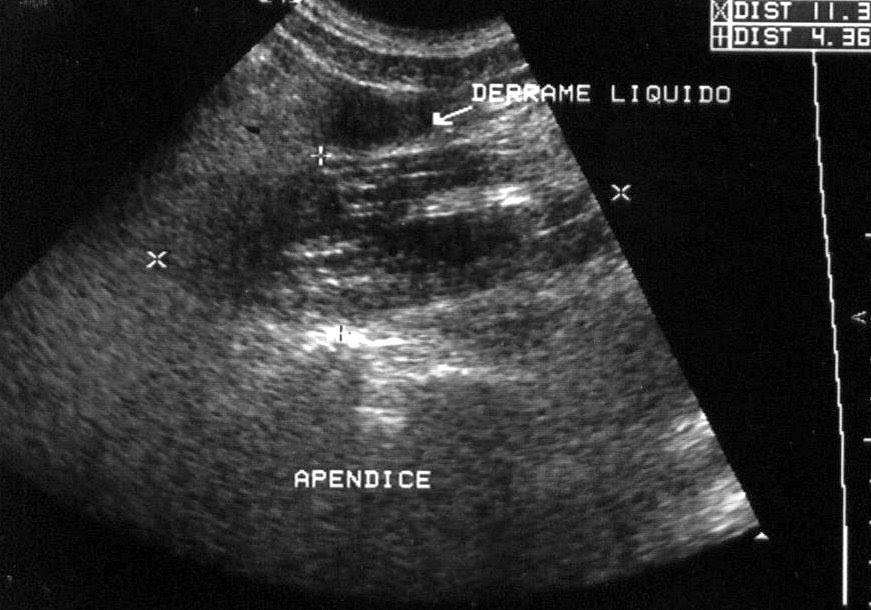 Apendicitis Por Sonografia