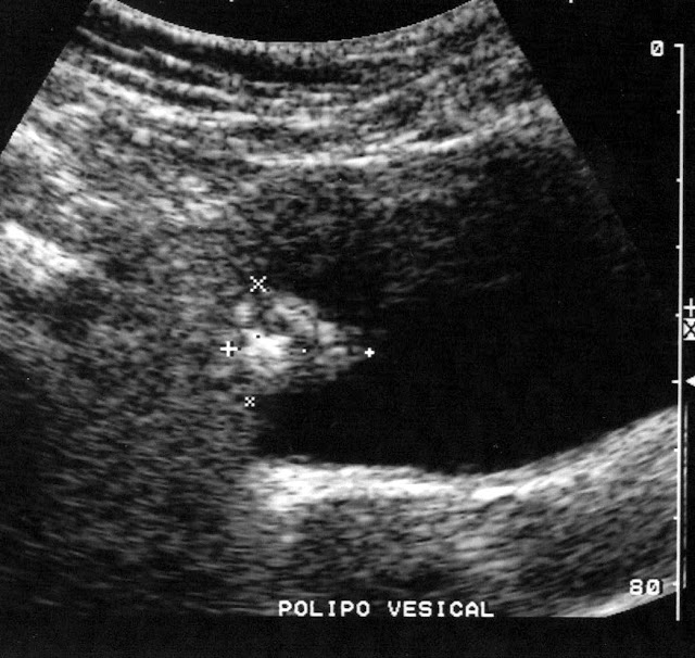 Lista 104+ Foto Imágenes De Pólipos En El útero Alta Definición ...