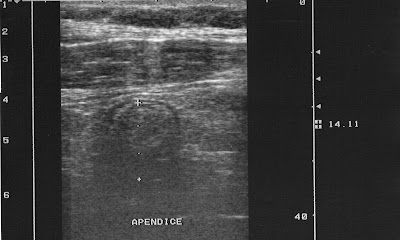 Apendicitis & Plastron Apendicular