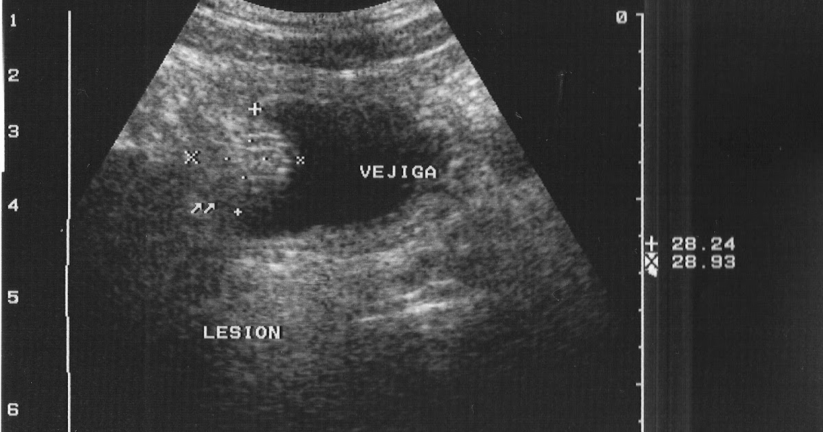 Polipo Vesical-2 Vistas-