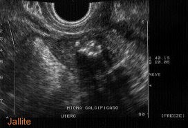 Mioma Uterino Calcificado