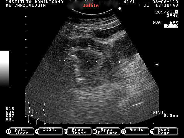Plastron Apendicular & Absceso Pelvico