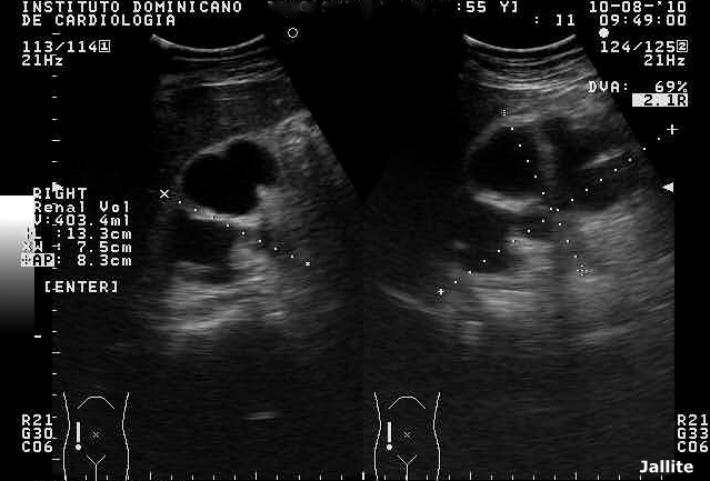 Hidronefrosis Derecha Grado III