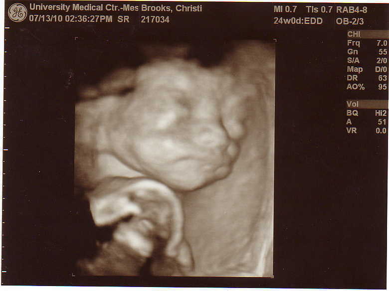 BabblingBrooks-CD: 6 Month (24 Week) Ultrasound