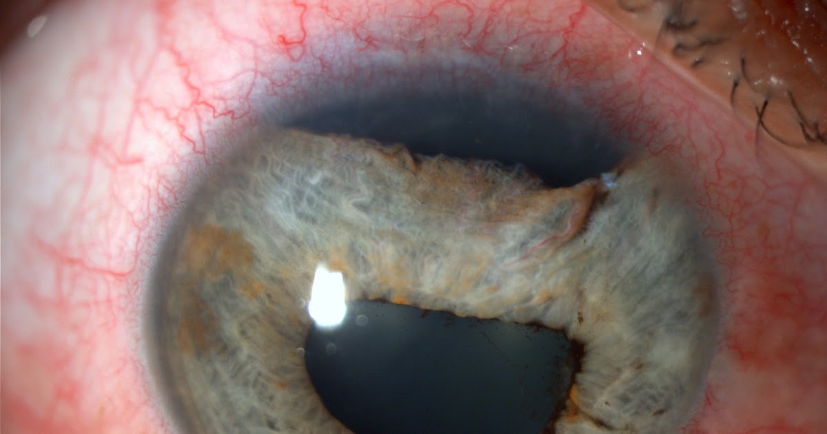 Dr. Marcelo REINHART - Cirugia INTRAocular: Reparacion de ...