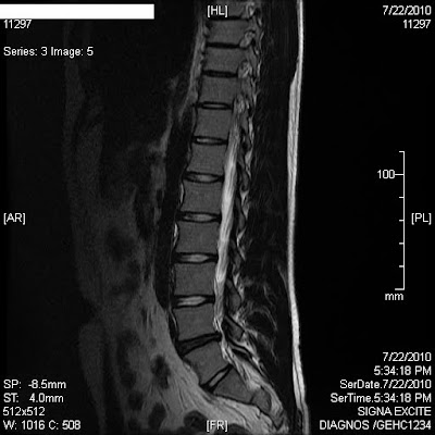 Medical Endeavors w/ my Herniated and Degenerative Lumbar Disc: MRI ...