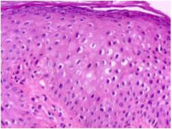 Virus De Papiloma Humano