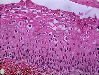 Virus De Papiloma Humano