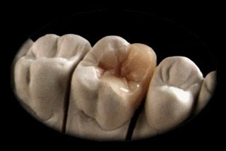 CLINICA DENTAL VALENCIA: * RESINAS / INCRUSTACIONES