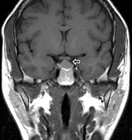 CT/MRI: Prolactinoma