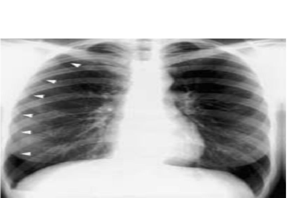 otoymarotoy: Catamenial Pneumothorax