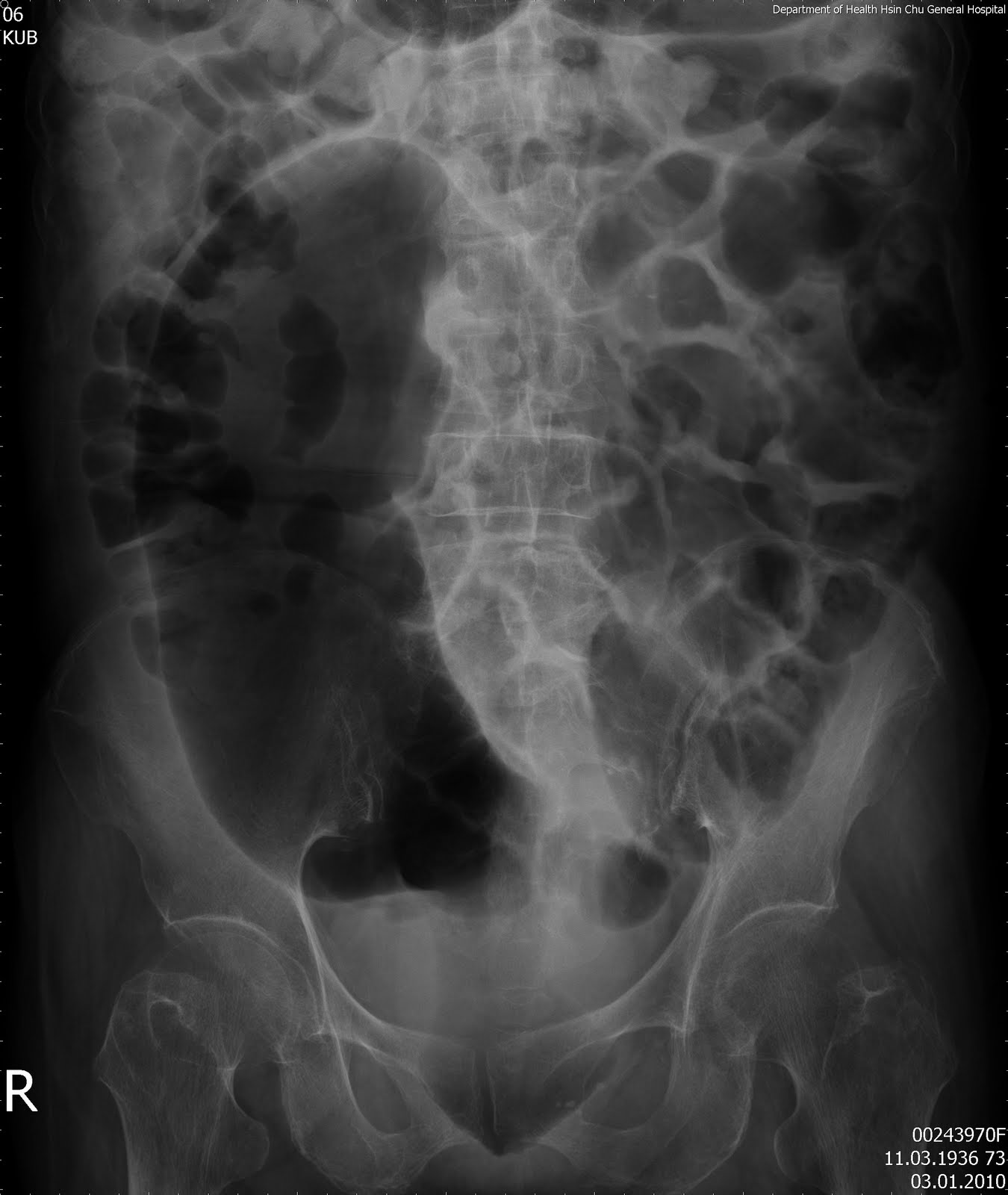 HCH_IM_CR: [GI] Sigmoid volvulus