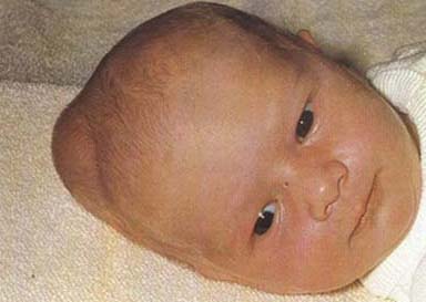 Midwifery Study Lhan@: Caput succedaneum & Cephal hematoma