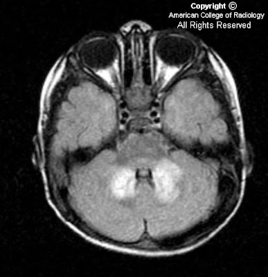 Neuroradiology On the Net: Acute disseminated encephalomyelitis (ADEM)