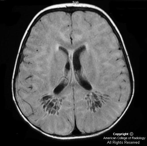 Neuroradiology On the Net: Mucopolysaccharidoses (MPS) / Hurler disease