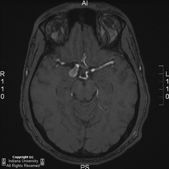 Neuroradiology On the Net: Right ICA aneurysm with oculomotor impingement