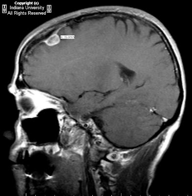 Neuroradiology On the Net: Meningioma