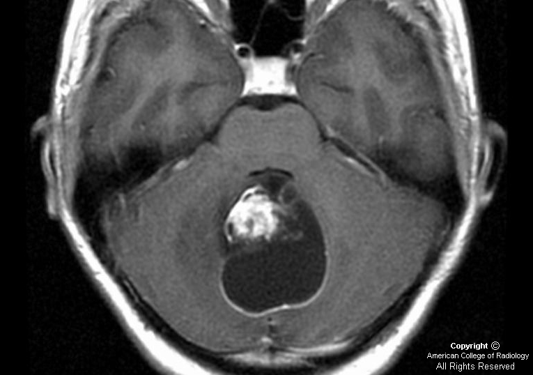Neuroradiology On the Net: Juvenile pilocytic astrocytoma