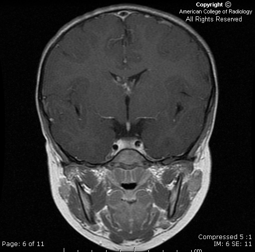 Neuroradiology On The Net Posterior Pituitary Ectopia