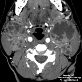 Neuroradiology On the Net: Scrofula