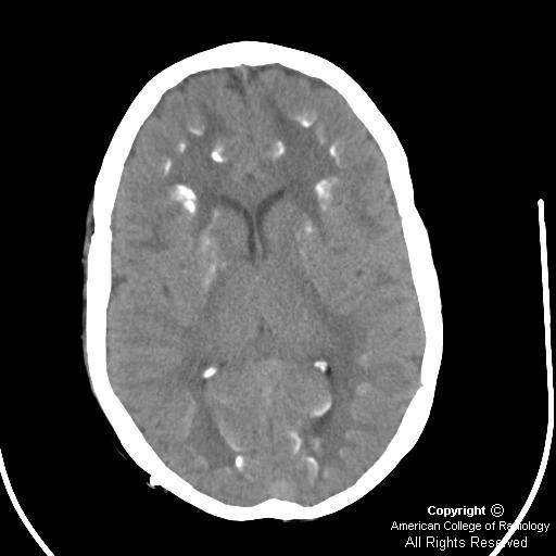 Neuroradiology On the Net: Mineralizing microangiopathy