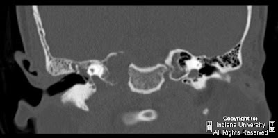 Holoprosencephaly: Right petrous apicitis (Gradenigo's syndrome clinically)