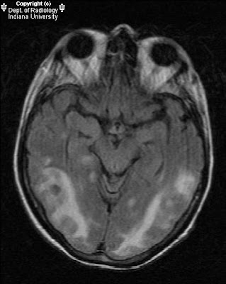 Neuroradiology On the Net: Lupus cerebritis