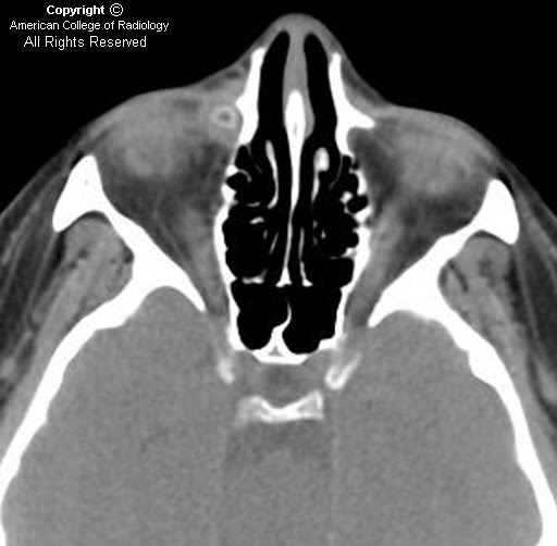 Neuroradiology On the Net: Dacryolithiasis complicated by dacryocystitis