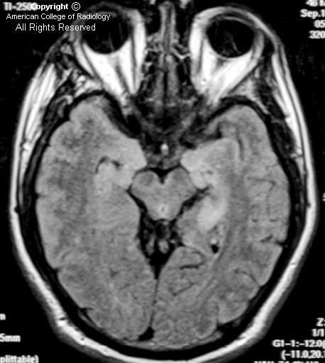 Neuroradiology On the Net: Postictal Imaging Findings